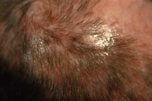 Tigna della pelle nell'uomo: sintomi, immagini e cura - The Wom Healthy