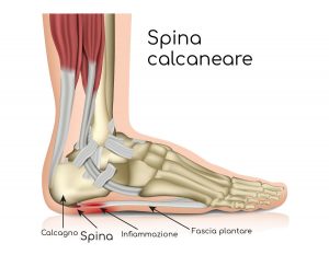 Tallonite (dolore al tallone): sintomi, cause, cura e rimedi - The Wom ...