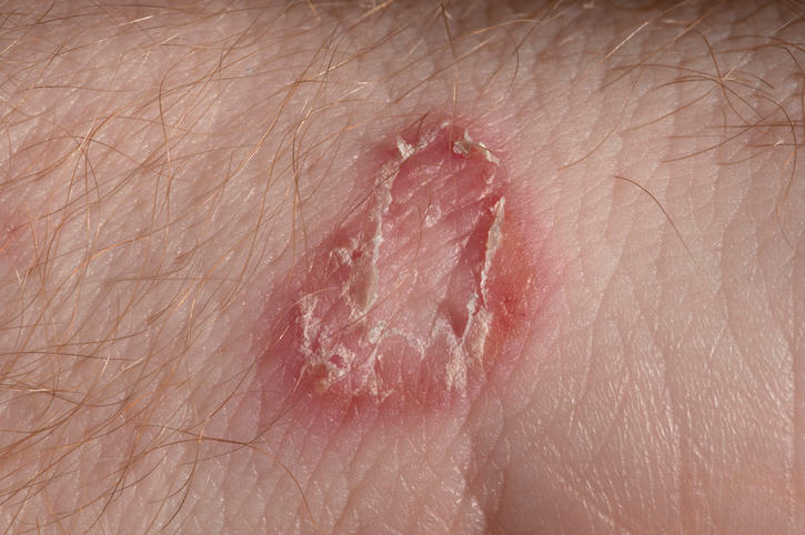 Tinea corporis (tigna della pelle): cause, sintomi e cura - The Wom Healthy