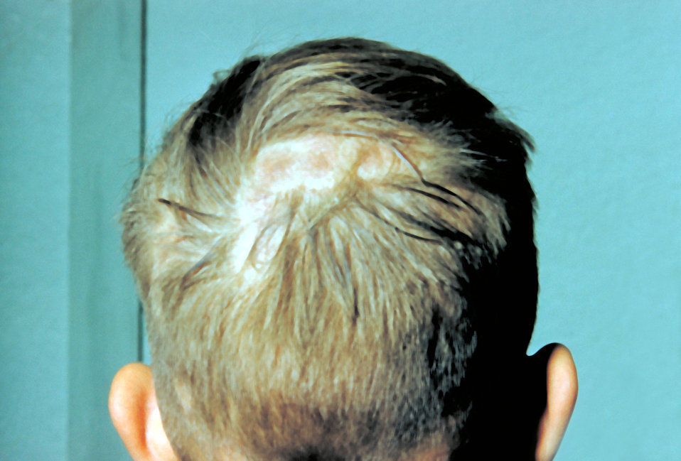 Tinea capitis (tigna ai capelli) nei bambini: sintomi e rimedi - The ...