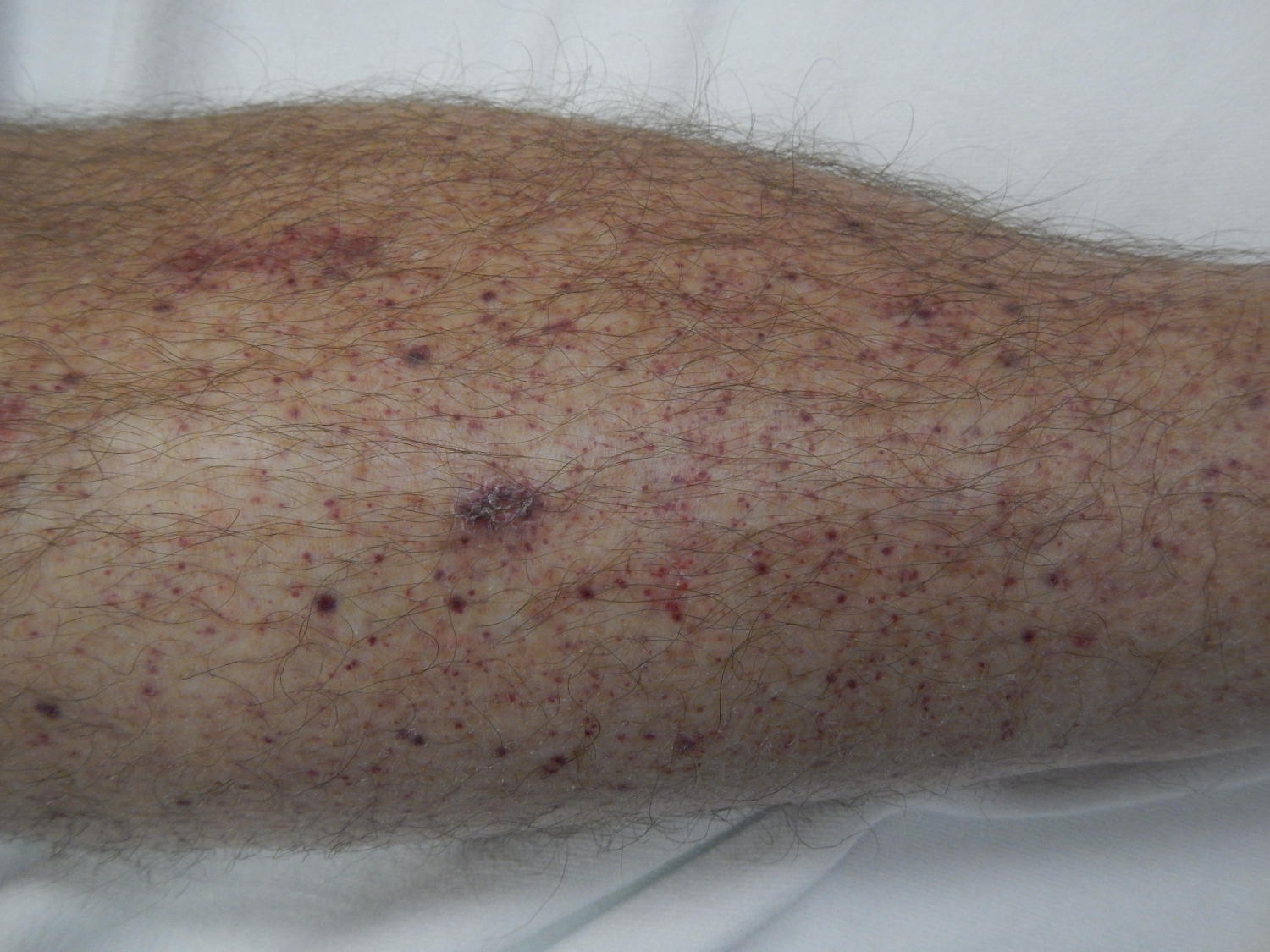 Leucemia fulminante: cause, sintomi e mortalità - The Wom Healthy