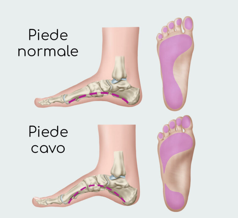 Piede cavo: sintomi, foto e conseguenze - The Wom Healthy