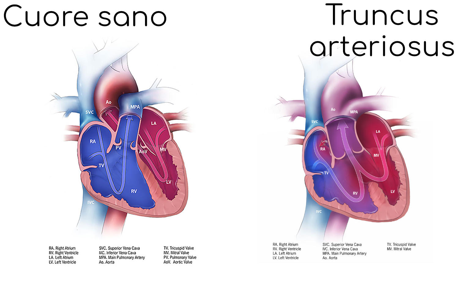 Truncus arteriosus (cardiopatia): cause, sintomi, pericoli e cura - The ...