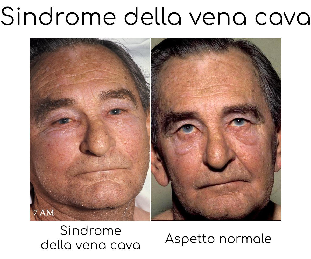 Sindrome della vena cava superiore: cause, sintomi e pericoli - The Wom ...