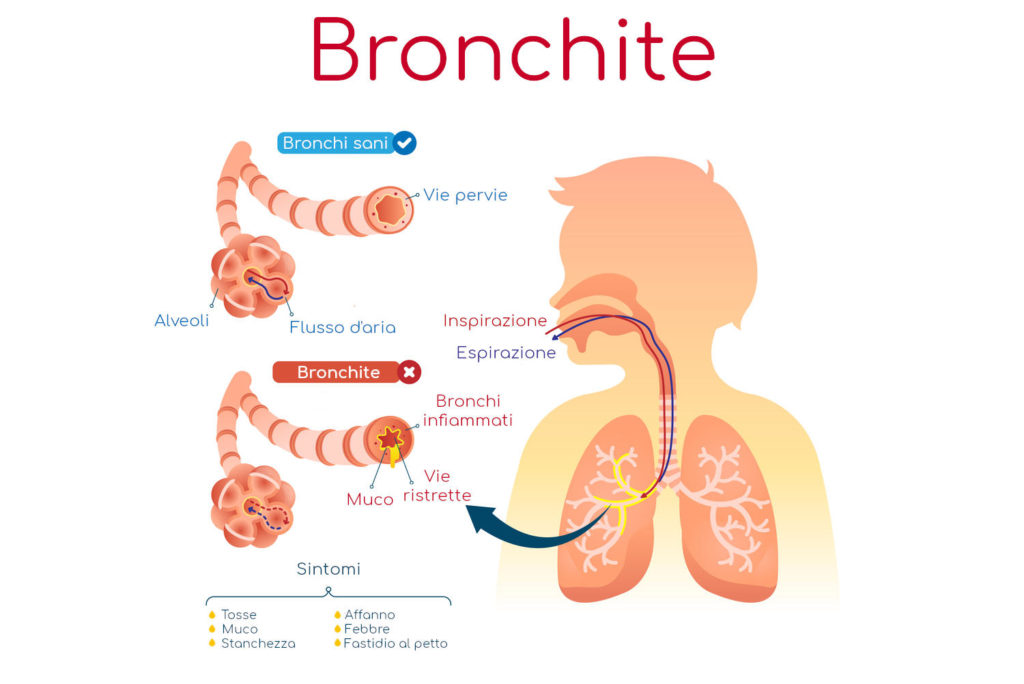 Bronchite acuta e cronica: sintomi, tosse, terapie, antibiotici