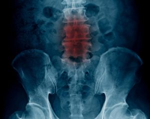 Spondilosi: cause, sintomi e cura