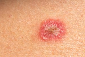 Tinea corporis (tigna della pelle): cause, sintomi e cura