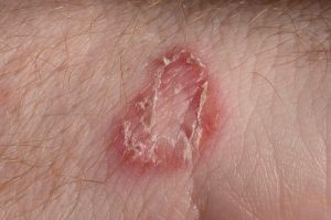 Tinea corporis (tigna della pelle): cause, sintomi e cura