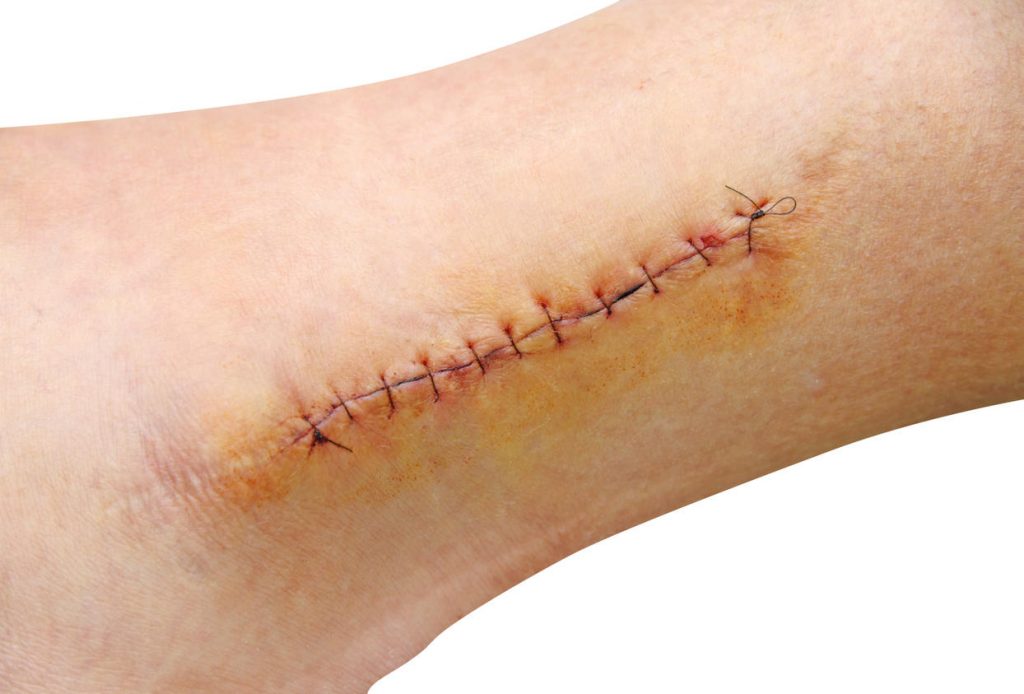 Medicazione Di Una Ferita Chirurgica Come Si Fa 
