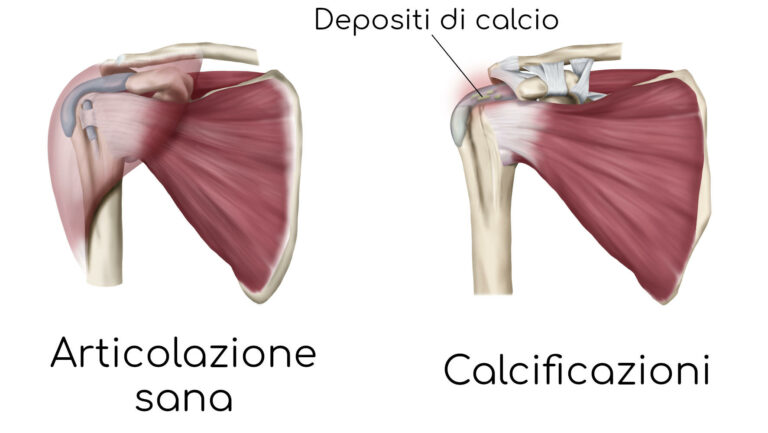 Tendinosi calcifica: cause, sintomi e cura